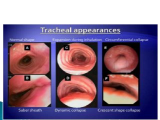 Postoperative Thyroid Surgery Complications | PPT