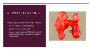 Thyroid Disorders | PPT