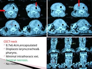 thyroid abscess ppt very rare case of thyroid abscess | PPTX