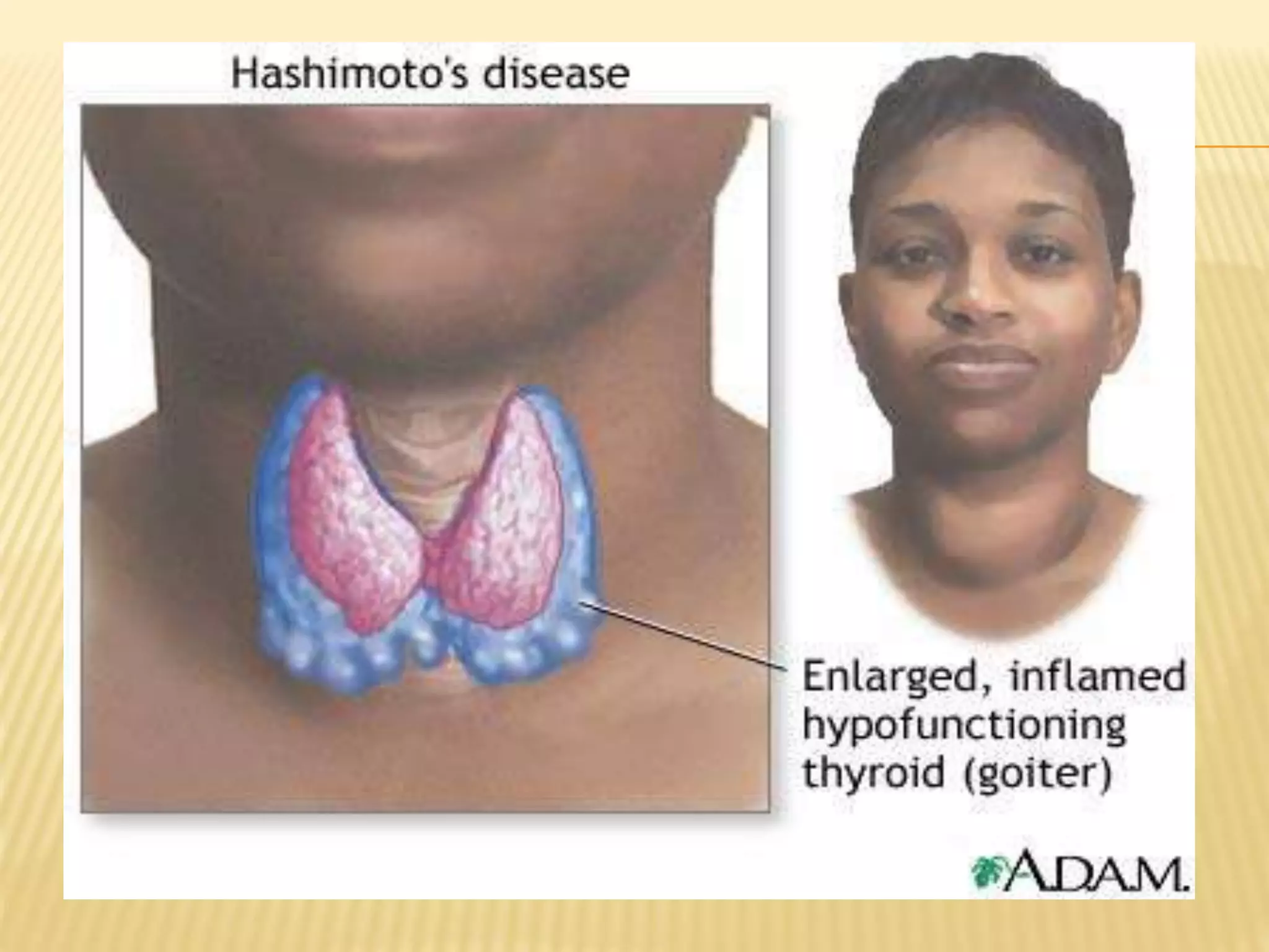 Thyroid anatomy and pathology | PPTX