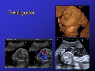 Thyroid and pregnancy | PPTX