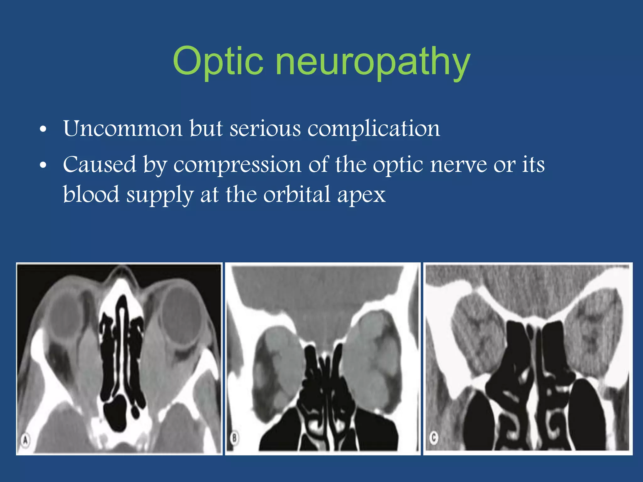 Thyroid associated orbitopathy of dr. sohel mahmud | PPTX