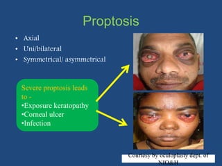 Thyroid associated orbitopathy of dr. sohel mahmud | PPTX