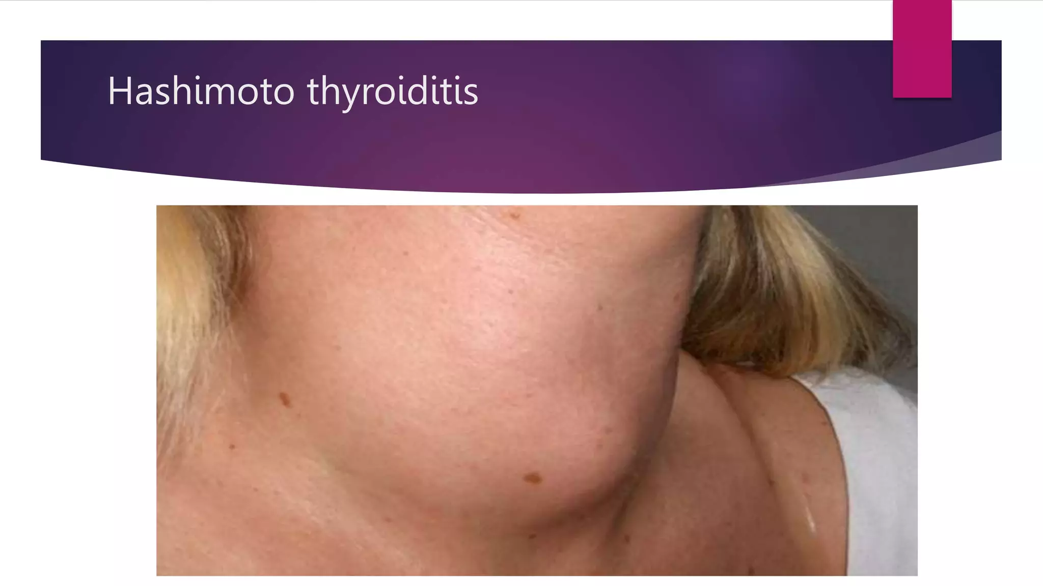 thyroid awarness.pptx