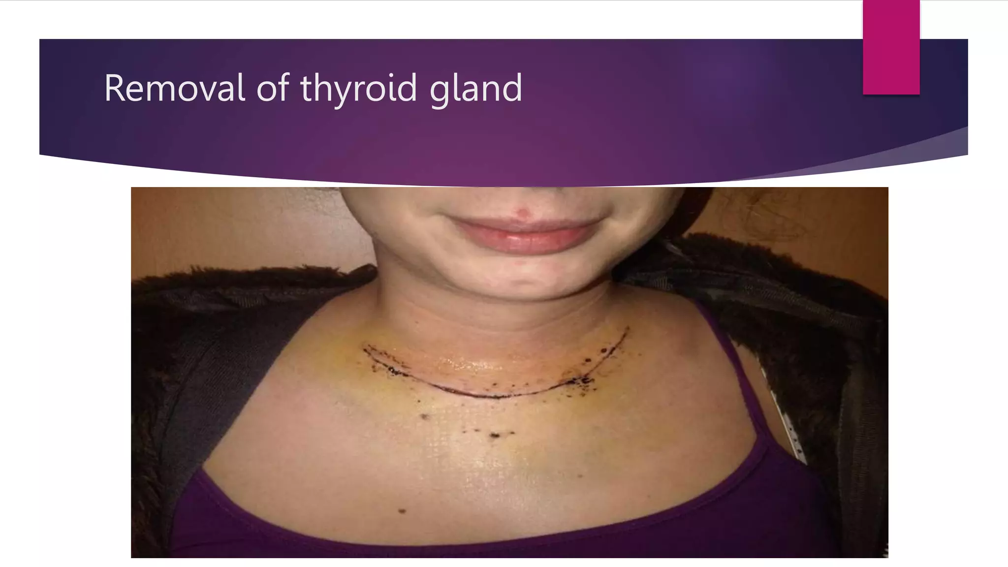 thyroid awarness.pptx