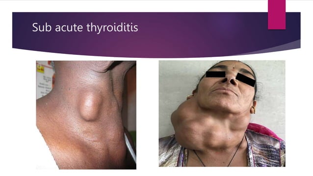 thyroid awarness.pptx