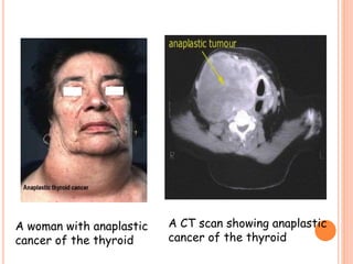 thyroidcancer-180217104356.pdf