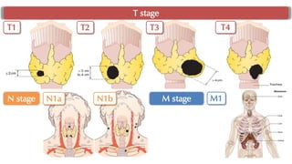 Thyroid cancer | PDF