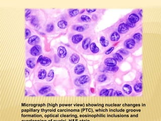 Thyroid cancer / papillary carcinoma (Doctor Faris Alabeedi MSc, MMedSc ...