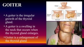 Nursing Management of patient with Endocrine disorder | PPTX