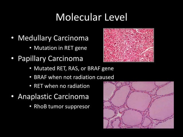 Thyroid Cancer Ppt Pptx Thyroid Disorders Endocrine And Metabolic Diseases