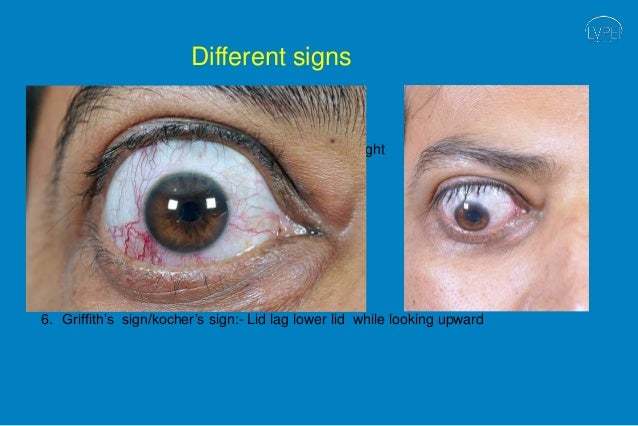 Thyroid case presentation
