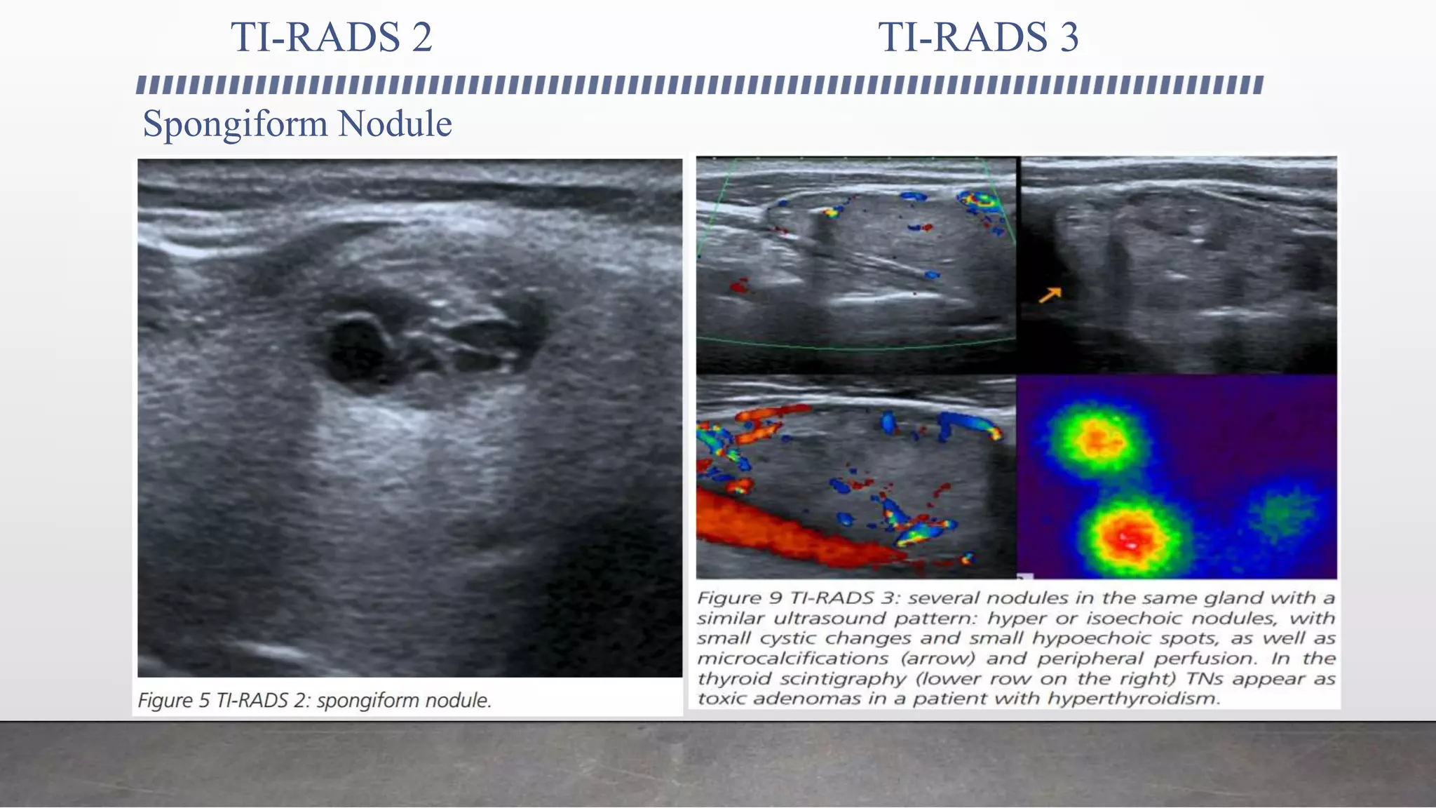 Cytohistological Correlation Of Malignant Thyroid Lesions | PPTX
