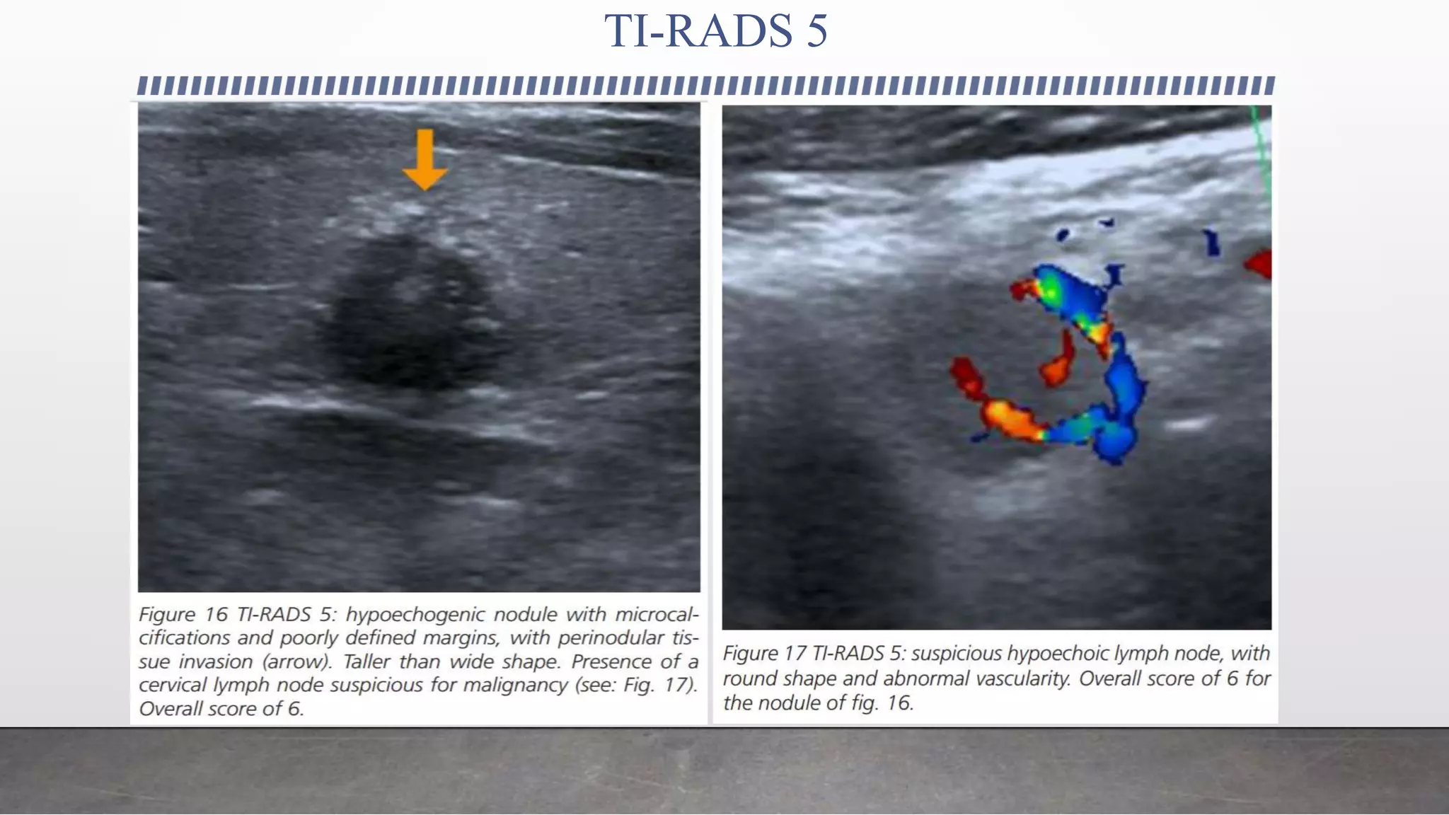 Cytohistological Correlation Of Malignant Thyroid Lesions | PPTX