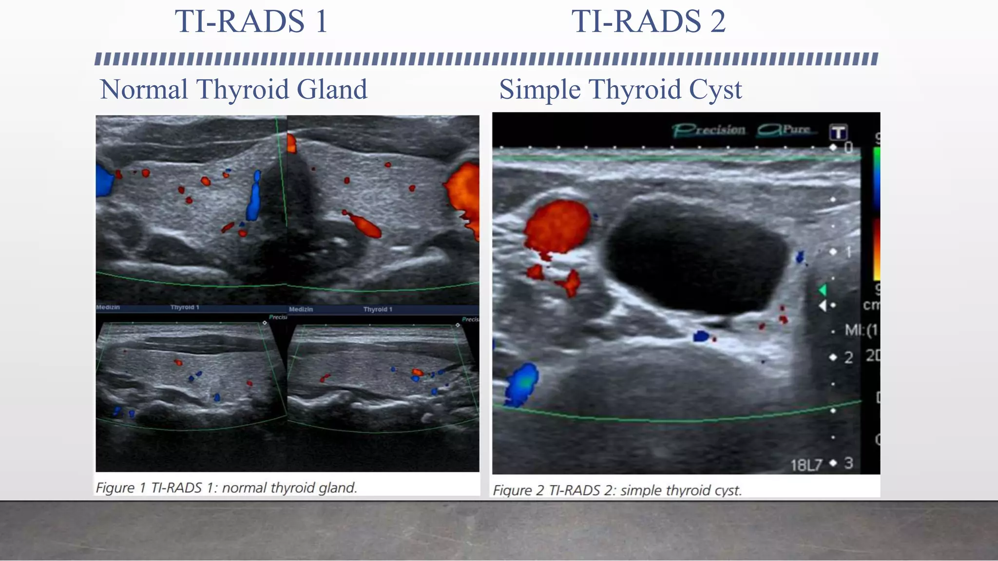 Cytohistological Correlation Of Malignant Thyroid Lesions | PPTX