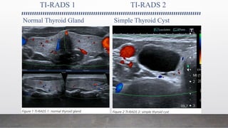 Cytohistological Correlation Of Malignant Thyroid Lesions | PPTX