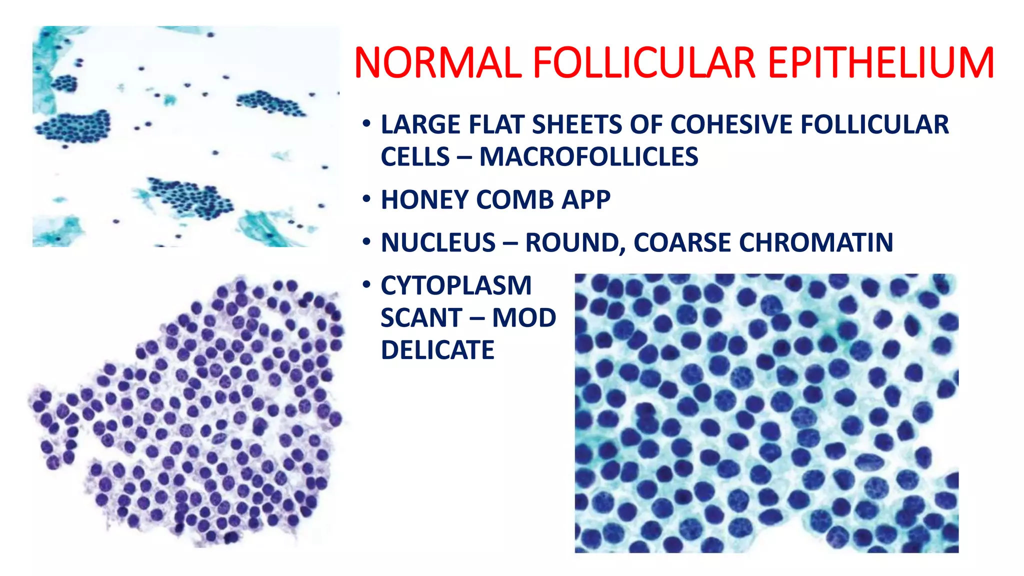 Papillary Carcinoma thyroid cytology.pptx