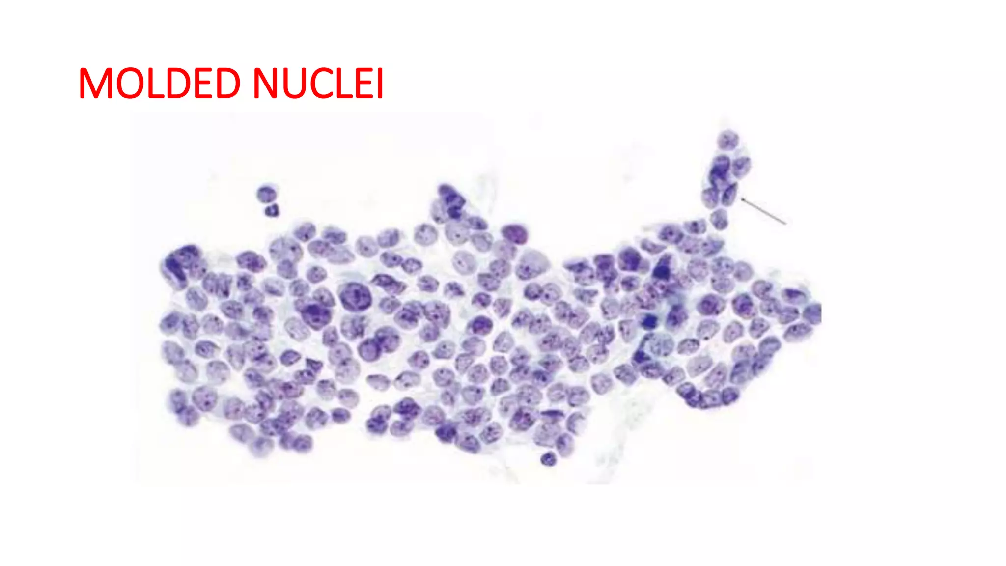 Papillary Carcinoma thyroid cytology.pptx