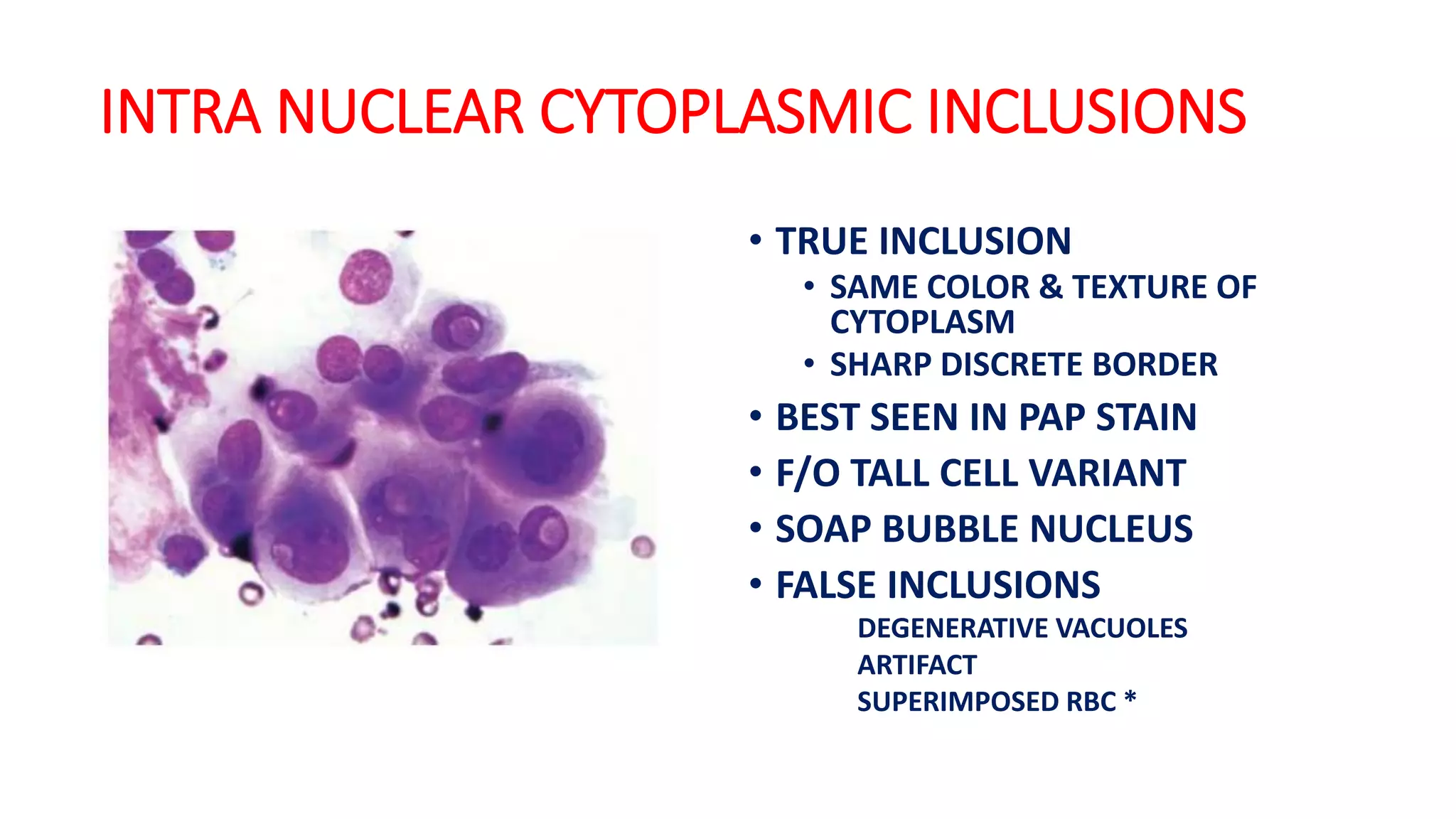 Papillary Carcinoma thyroid cytology.pptx