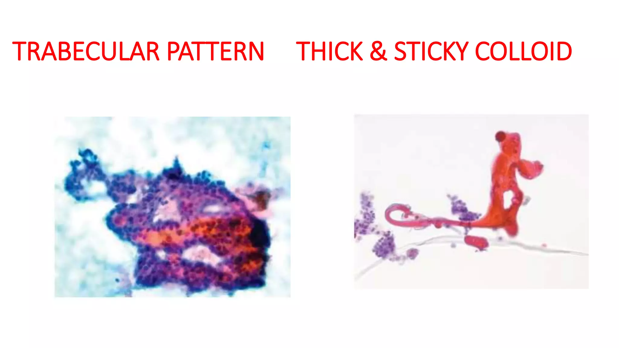 Papillary Carcinoma thyroid cytology.pptx