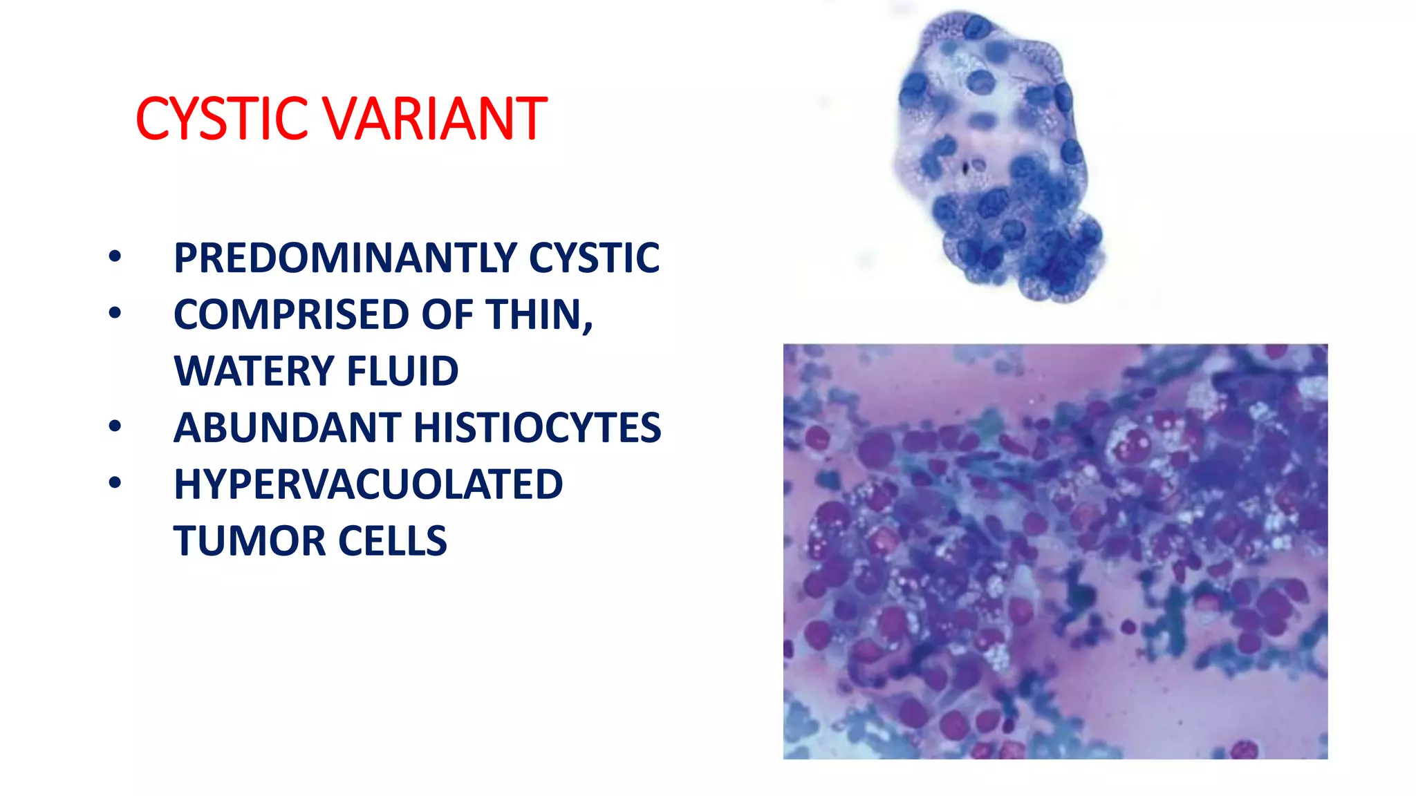 Papillary Carcinoma thyroid cytology.pptx