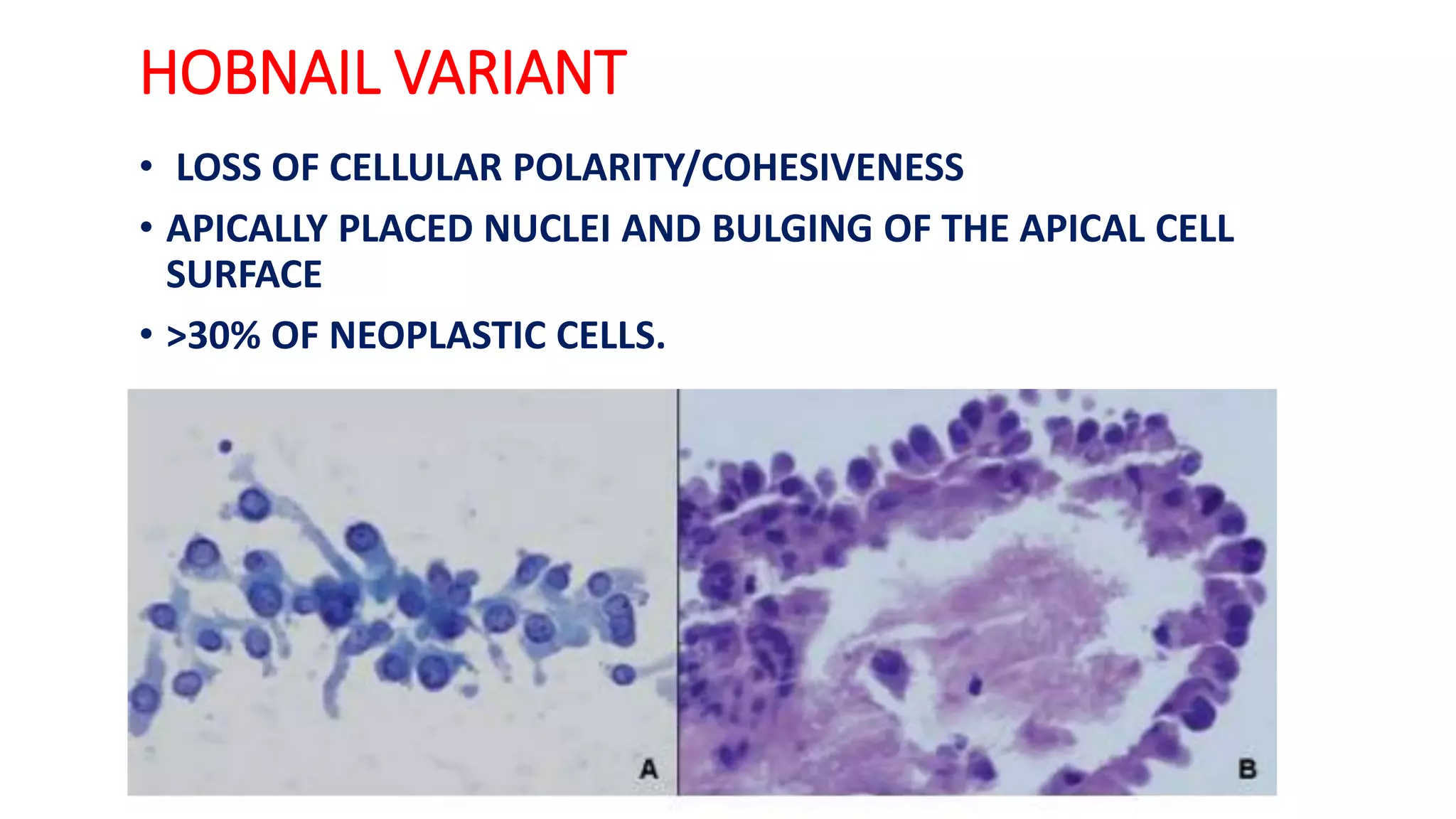 Papillary Carcinoma thyroid cytology.pptx