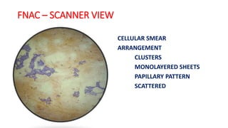 Papillary Carcinoma thyroid cytology.pptx