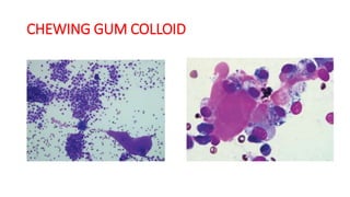 Papillary Carcinoma thyroid cytology.pptx