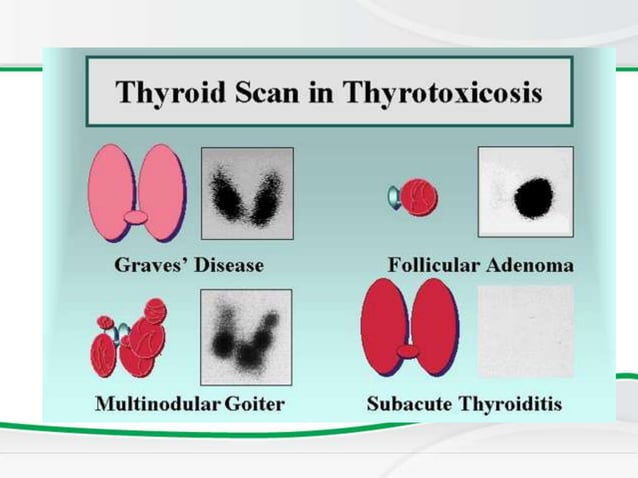 Thyroid Diseases.ppt | Thyroid Disorders | Endocrine and Metabolic Diseases