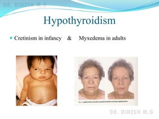 Congenital Hypothyroidism Adults