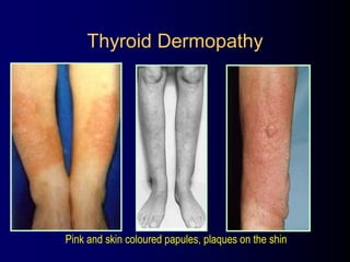 Thyroid disorders (hyperthyroidism & hypothyroidism) | PDF