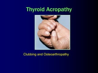 Thyroid disorders (hyperthyroidism & hypothyroidism) | PDF