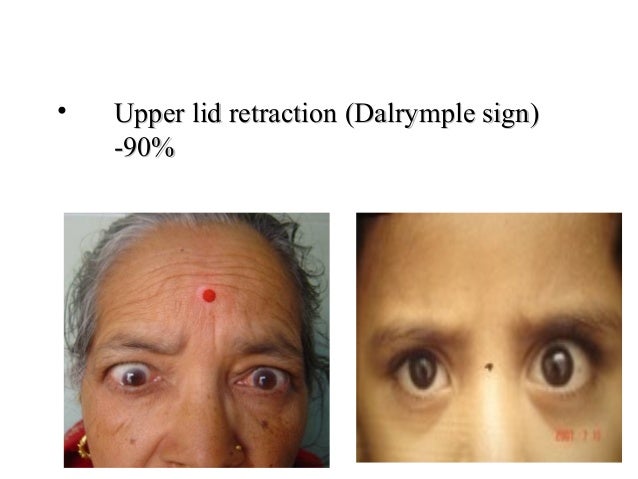 Thyroid disorders Part 1