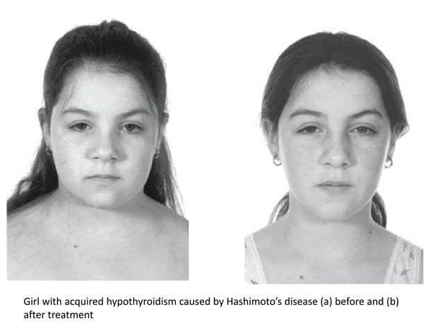 Thyroid disorders in children | PPTX