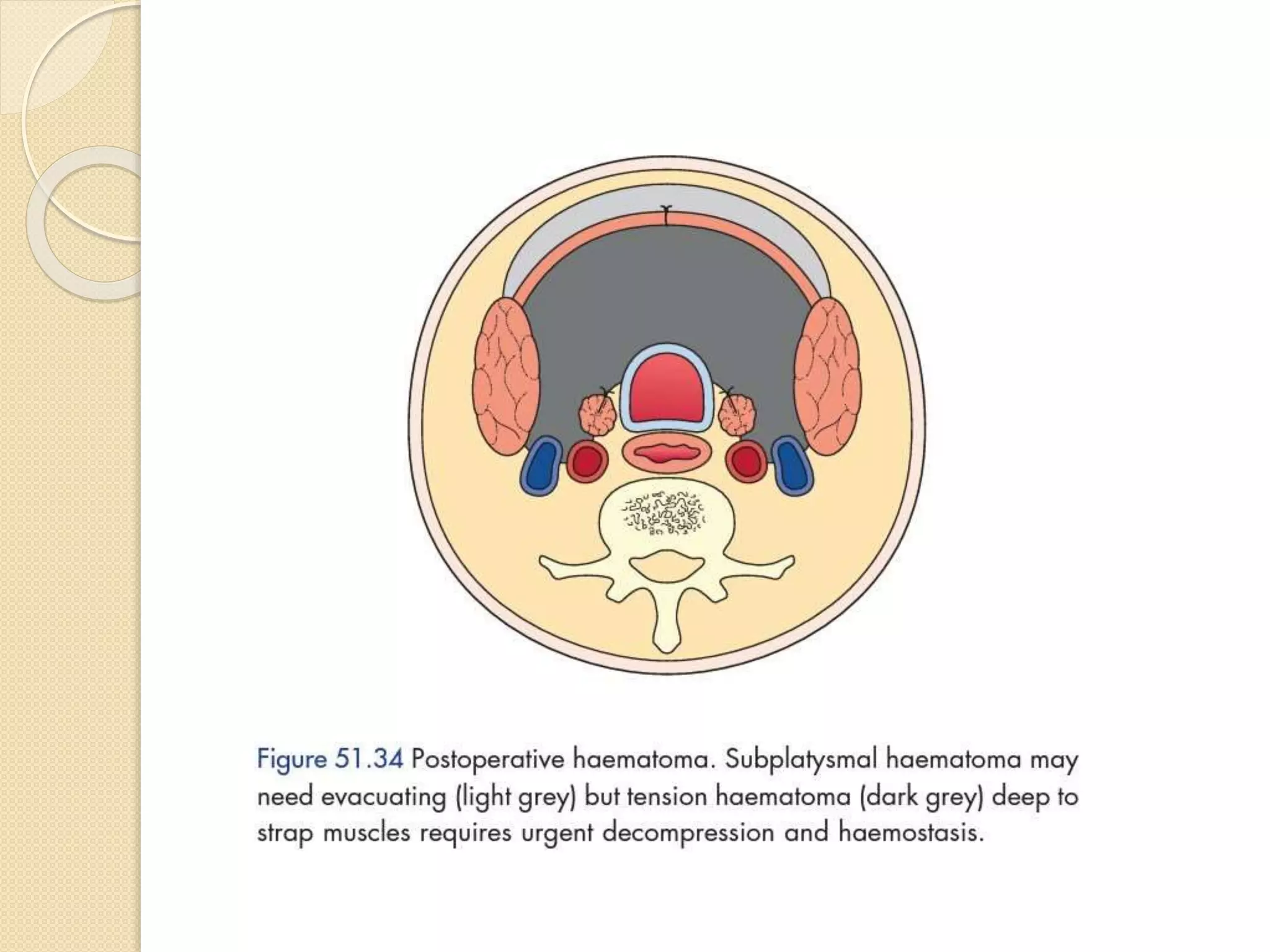 Thyroidectomy Pptx