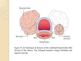 Thyroidectomy | PPTX