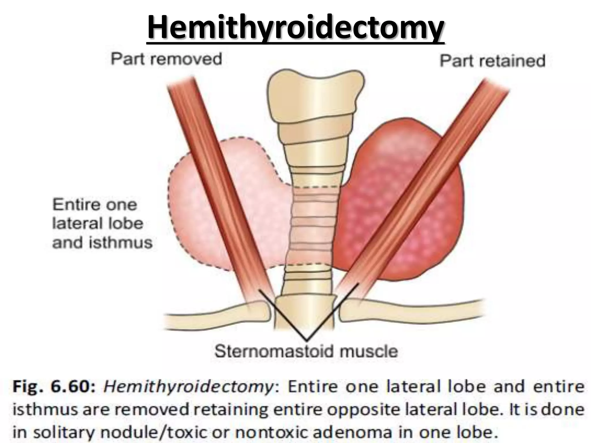 Thyroidectomy | PPTX