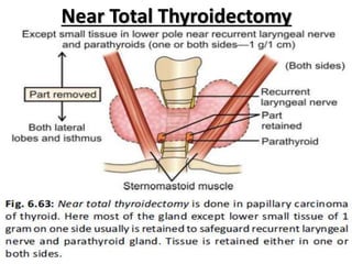 Thyroidectomy | PPTX