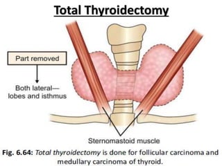 Thyroidectomy | PPTX