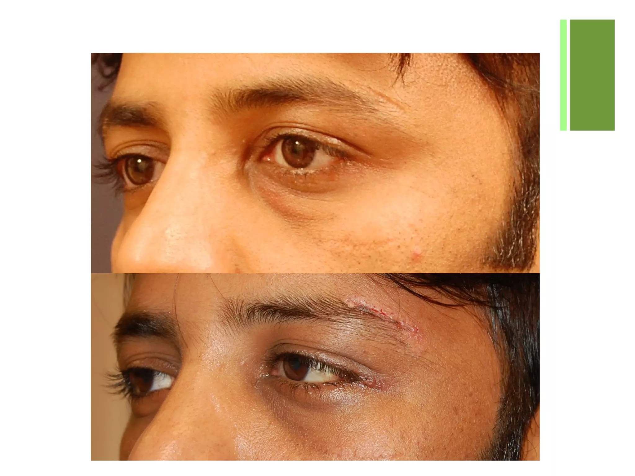 gytThyroidectomy and-reconstructive-eye-surgery | PPT