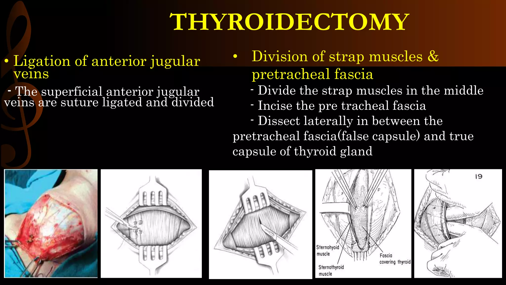 Thyroidectomy- operative surgery | PPTX
