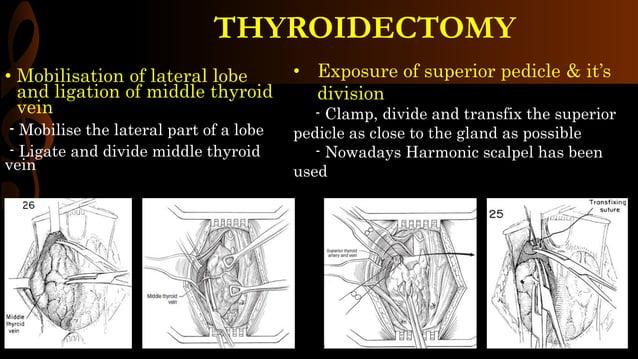 Thyroidectomy- operative surgery | PPTX