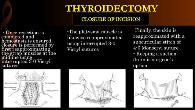 Thyroidectomy- operative surgery