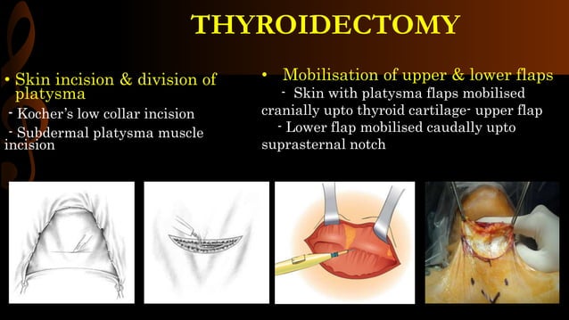 Thyroidectomy- operative surgery