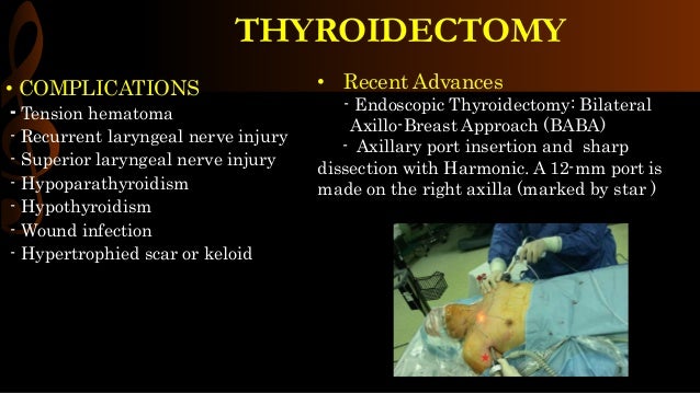 Thyroidectomy- operative surgery
