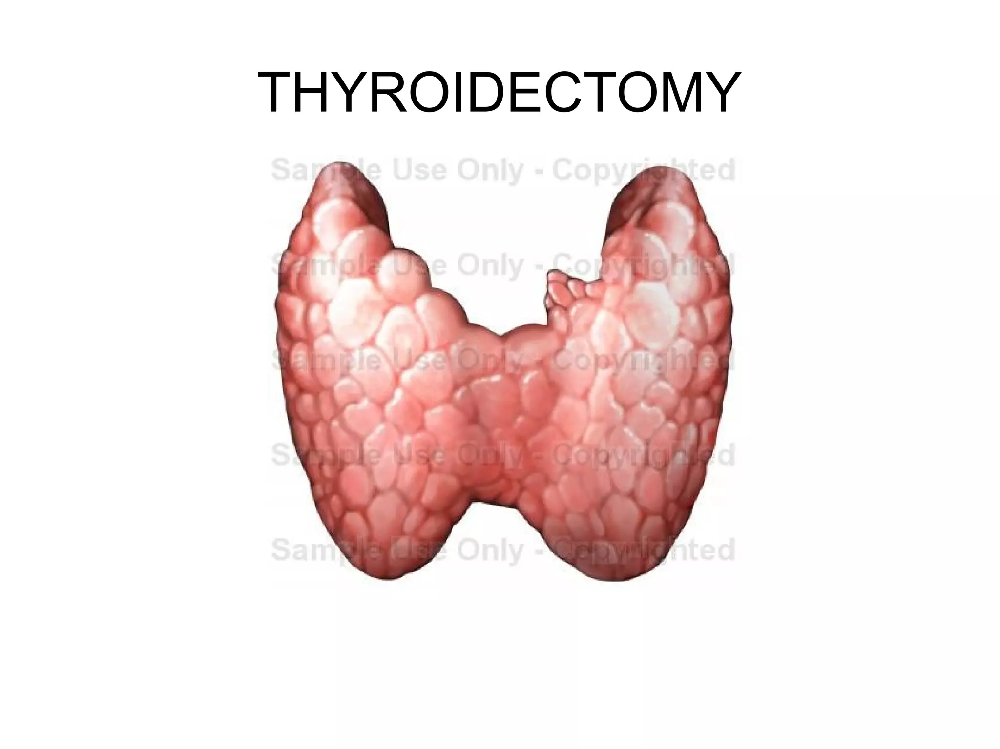 Thyroidectomy | ODP