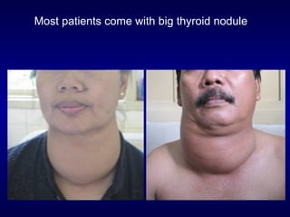 Total Open Thyroidectomy Techniqueslecture.ppt