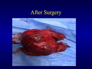 Total Open Thyroidectomy Techniqueslecture.ppt