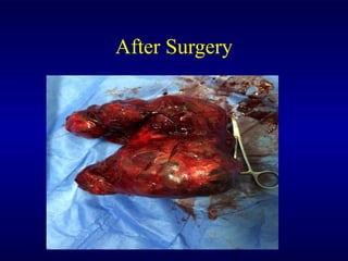 Total Open Thyroidectomy Techniqueslecture.ppt