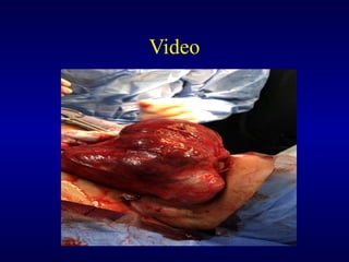 Total Open Thyroidectomy Techniqueslecture.ppt
